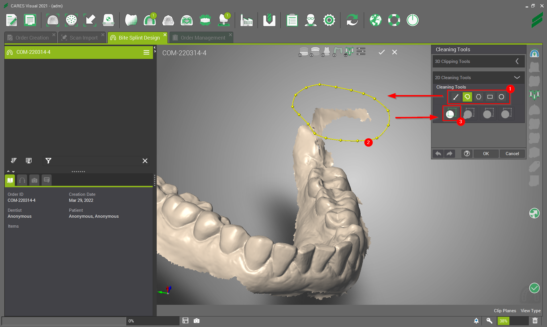 CAD - How to correct the unwanted bite space created by the virtual ...