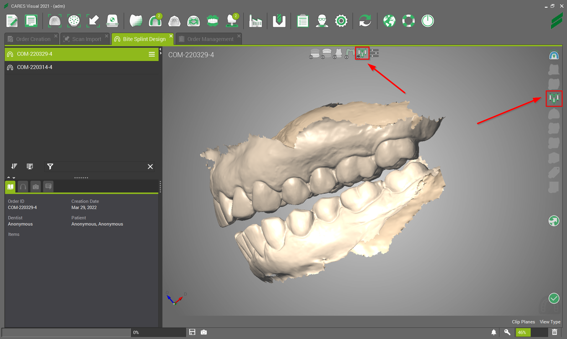 CAD - How to correct the unwanted bite space created by the virtual ...